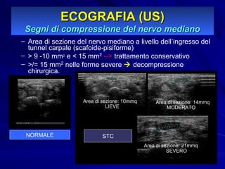 Sindrome del tunnel carpale - Diagnostica per Immagini | PPT