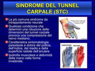 Sindrome del tunnel carpale - Diagnostica per Immagini | PPT