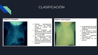Síndrome de mala adaptación pulmonar.pdf