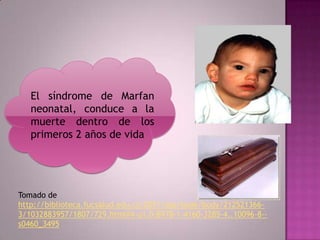 SINDROME DE MARFAN | PPTX
