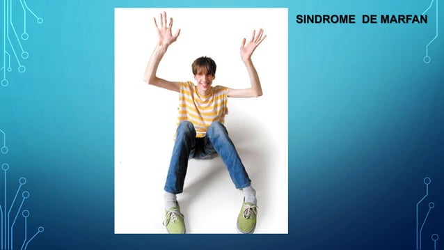 sindrome de marfan.pptx