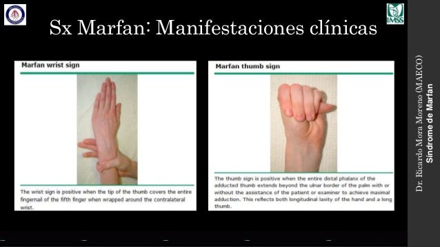 Sindrome de marfan