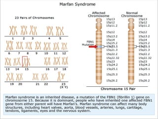 SINDROME DE MARFAN . | PPT