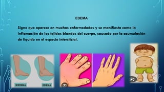 sindrome Edematoso aplicado en emergencias | PPTX