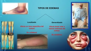 sindrome Edematoso aplicado en emergencias | PPTX