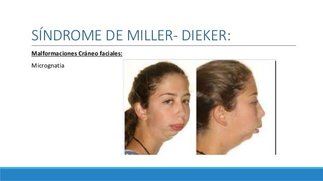 Sindrome de miller dieker