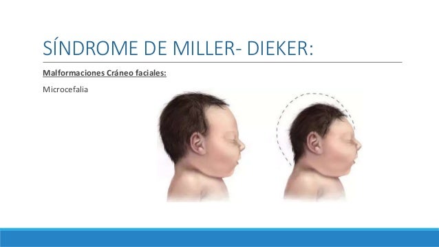 Sindrome de miller dieker