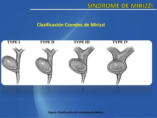 Sindrome de mirizzi