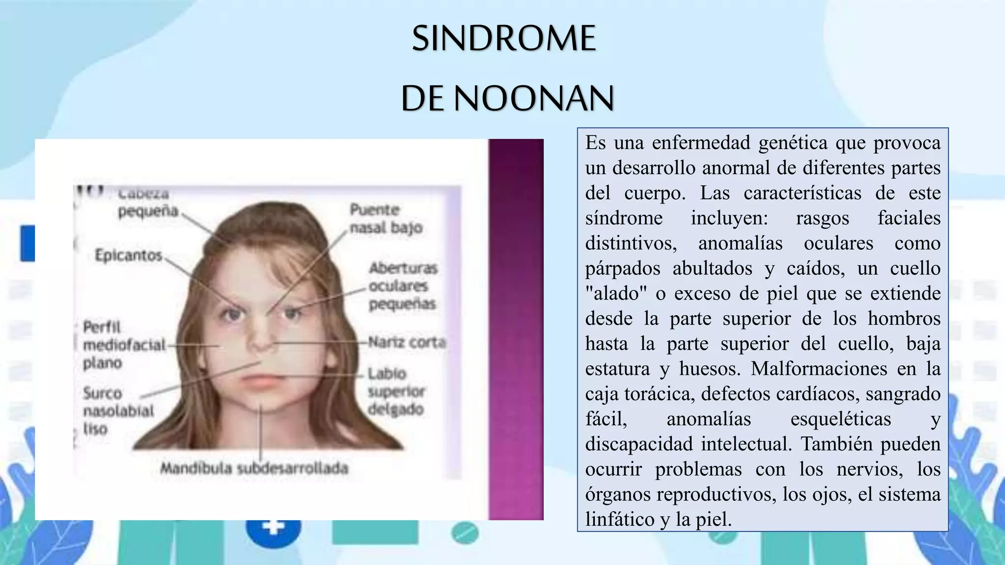 sindrome de noonan.pptx
