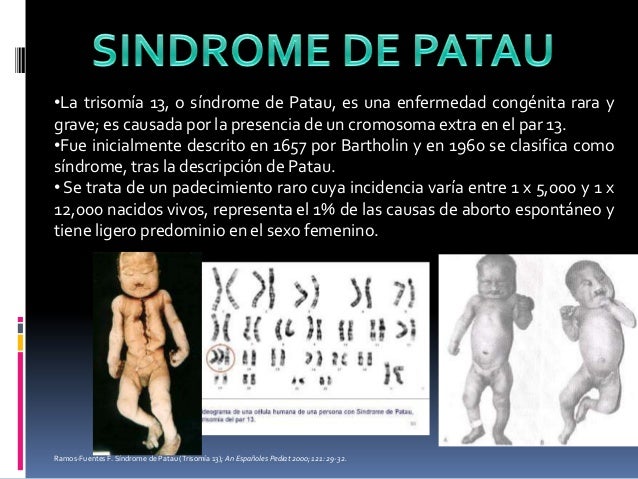 Sindrome de patau