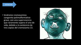 Sindrome de Patau | PPTX