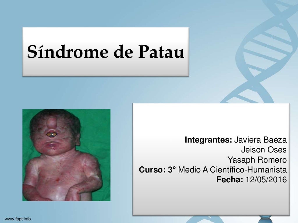 Sindrome De Patau