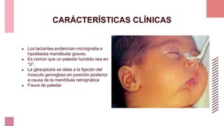 SINDROME DE PIERRE ROBIN.pptx