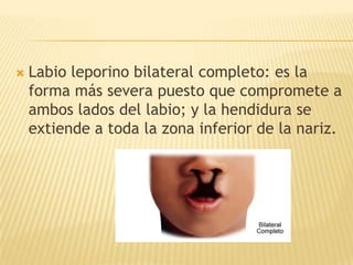 Sindrome de pierre robin pp | PPTX