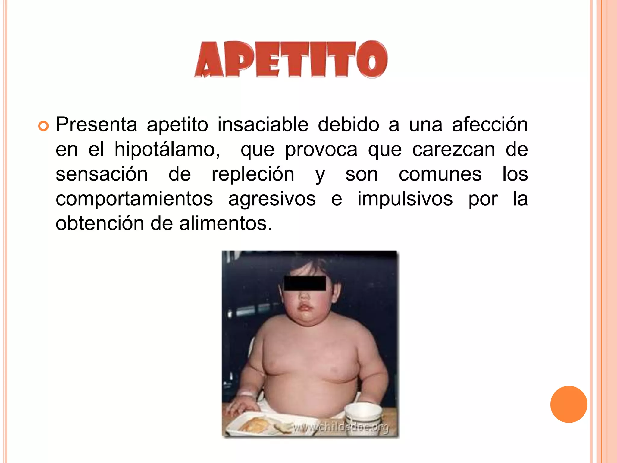 Sindrome de prader willi | PPT