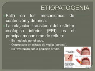 Sindrome de reflujo gastroesofagico | PPTX