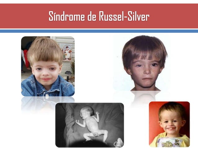 Sindrome de russel silver | PPTX