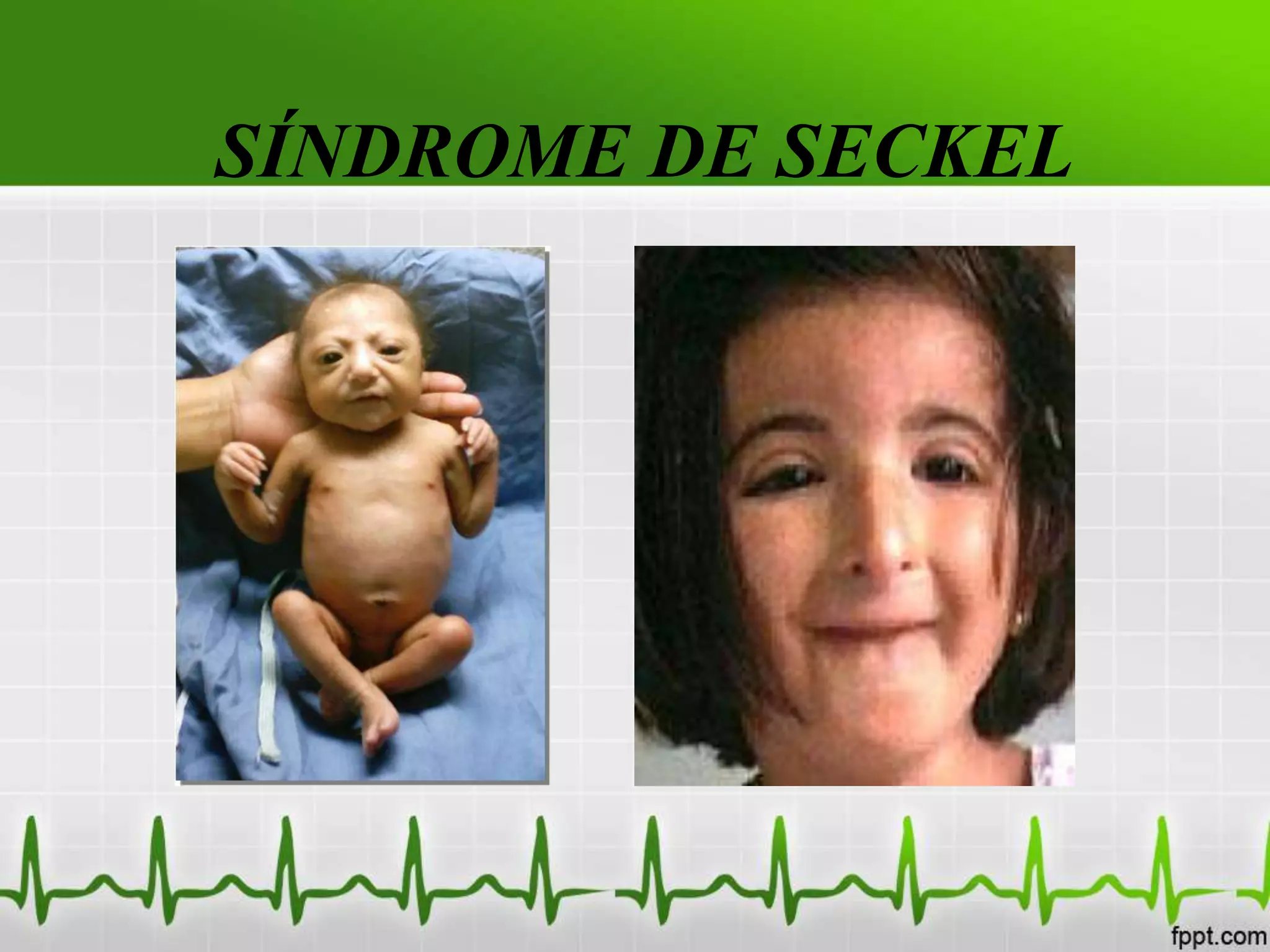 Sindrome de seckel thalia | PPTX