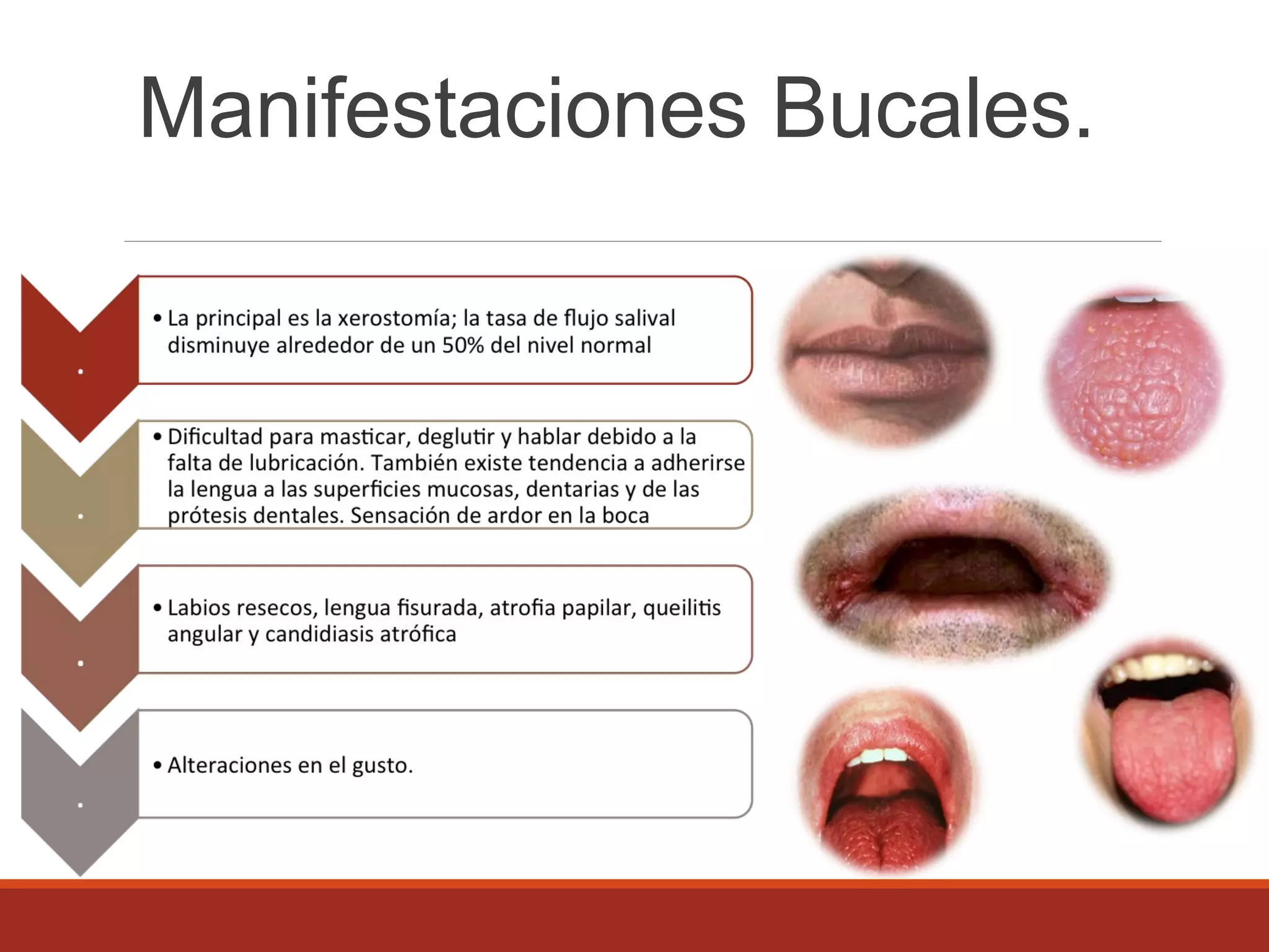 Sindrome de sjogren | PPT