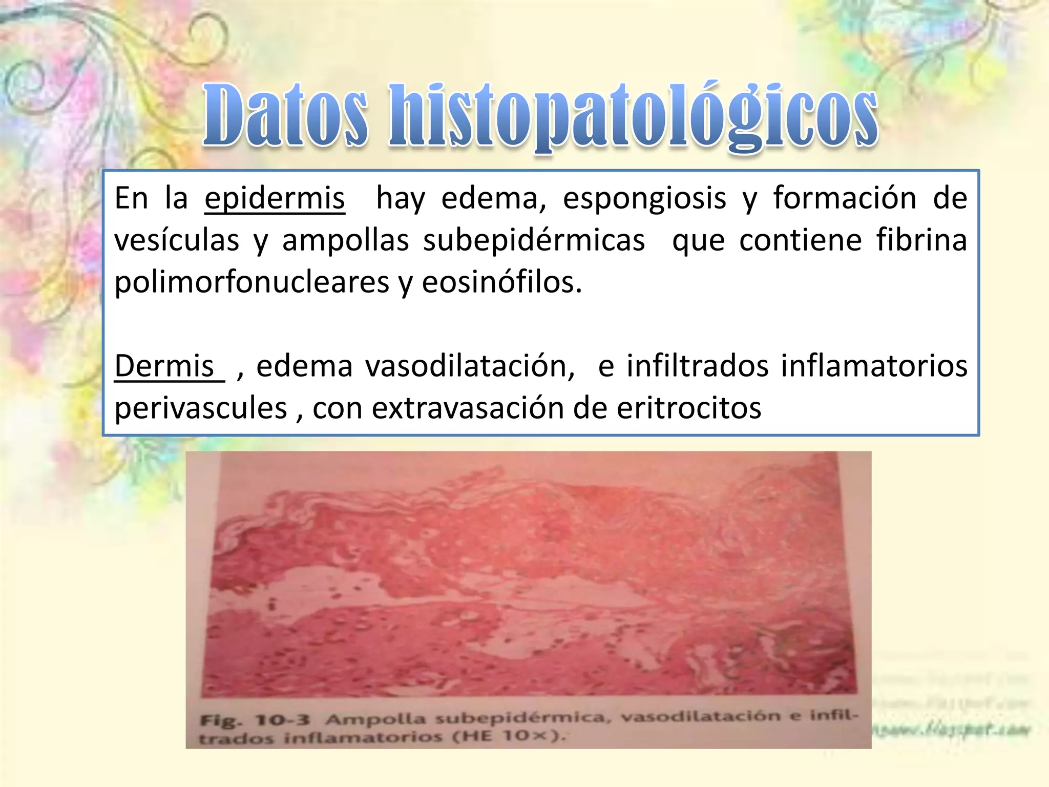 Sindrome de stevens johnson | PPT Sindrome de stevens johnson | PPT