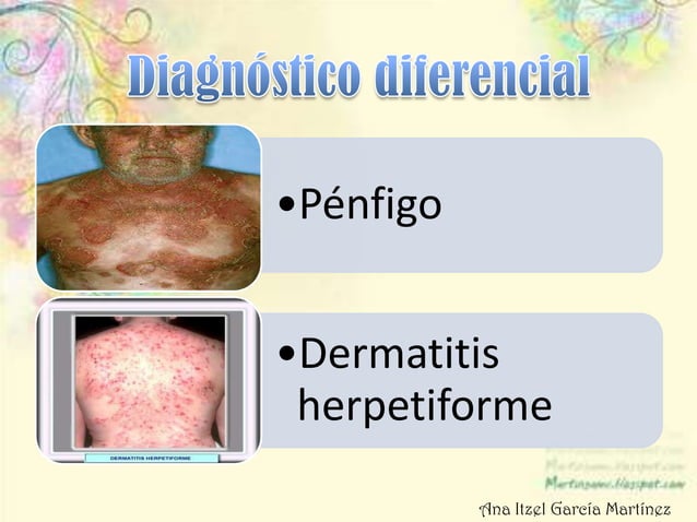 Sindrome de stevens johnson | PPT Sindrome de stevens johnson | PPT