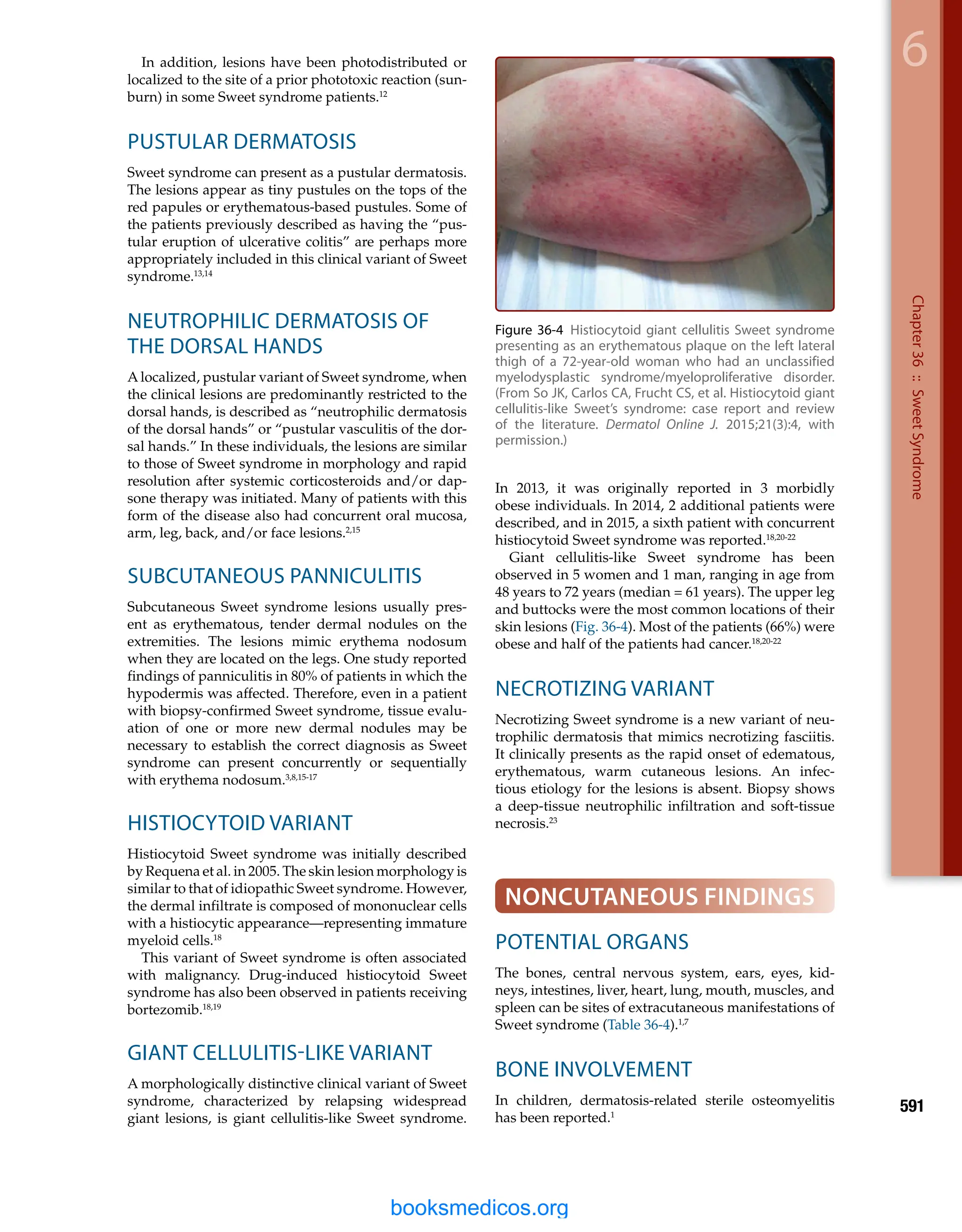 Dermatosis neutrofilicas variante síndrome sweet | PDF