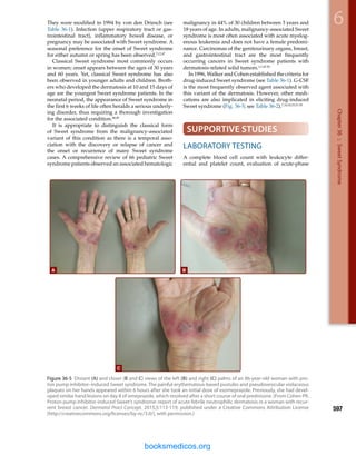 Dermatosis neutrofilicas variante síndrome sweet | PDF