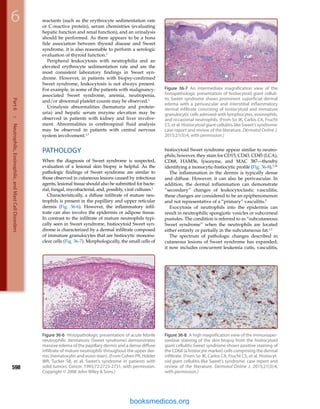 Dermatosis neutrofilicas variante síndrome sweet | PDF