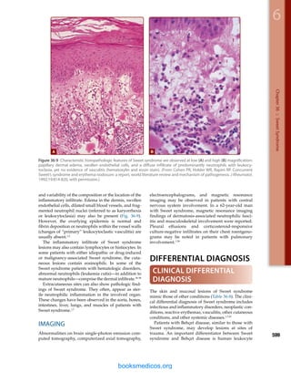 Dermatosis neutrofilicas variante síndrome sweet | PDF