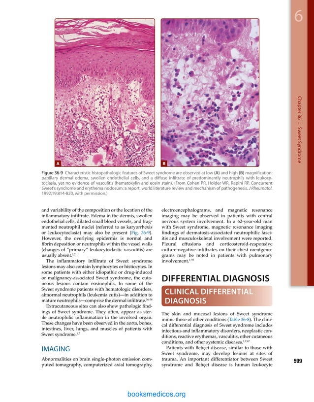 Dermatosis neutrofilicas variante síndrome sweet | PDF