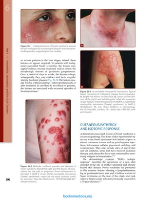 Dermatosis neutrofilicas variante síndrome sweet | PDF