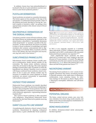 Dermatosis neutrofilicas variante síndrome sweet | PDF