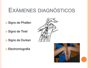 Sindrome de tunel carpiano | PPT