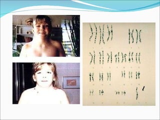 Sindrome de tuner | PPT