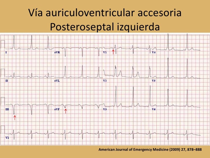 Sindrome de Wolff - Parkinson - White
