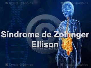 Sindrome de zollinger ellison | PPTX