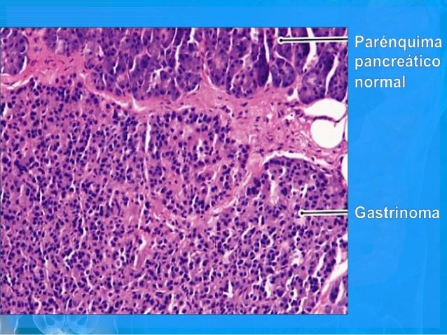 Zollinger Ellison Sindrome
