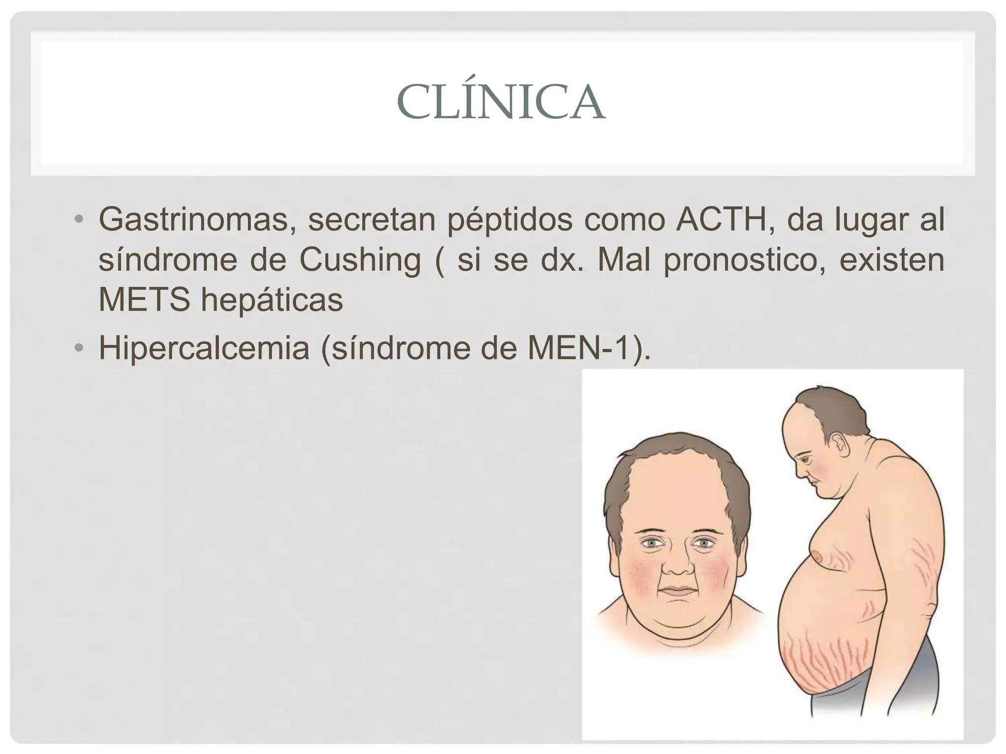 Sindrome de zollinger ellison | PPTX