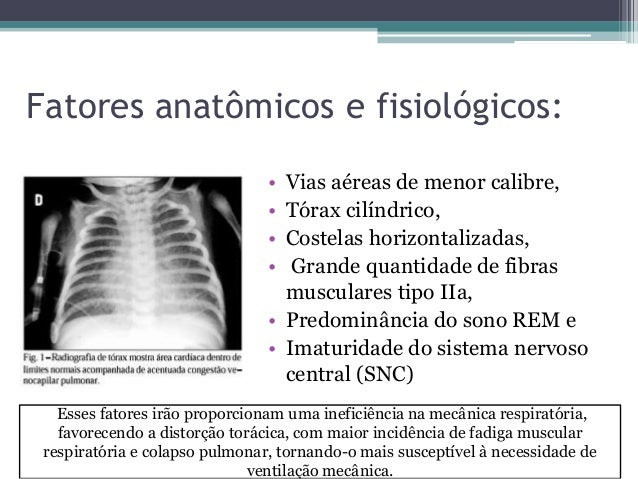Sindrome Do Desconforto Respiratorio Vidro Fosco