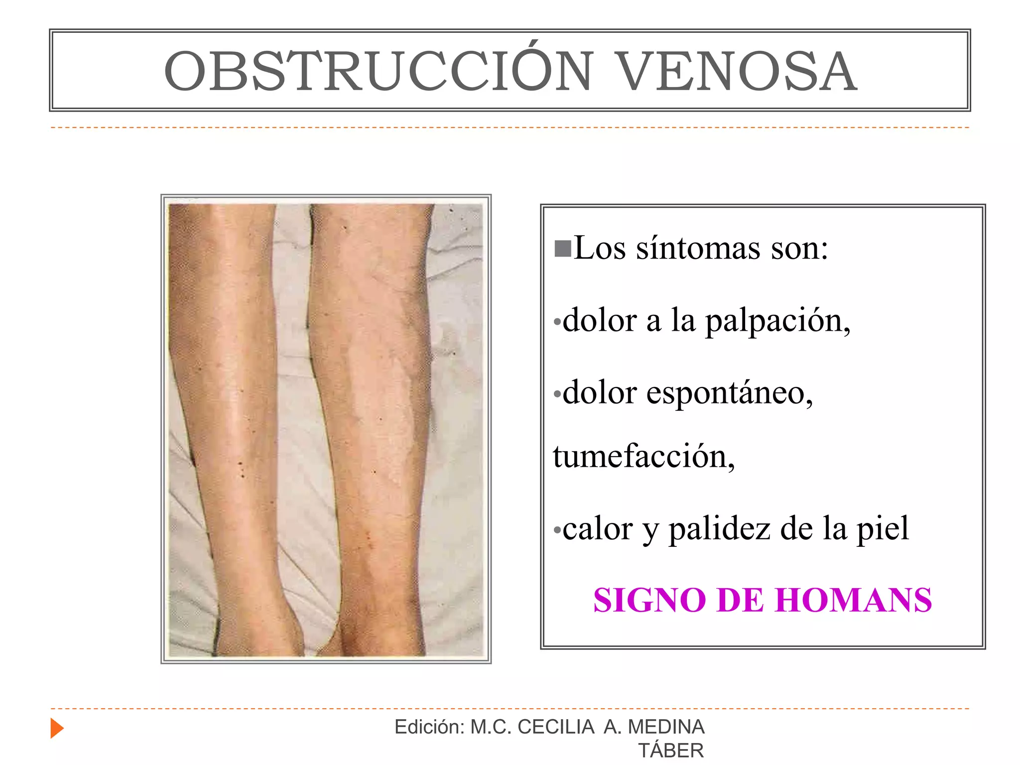 Sindrome edematoso | PPTX
