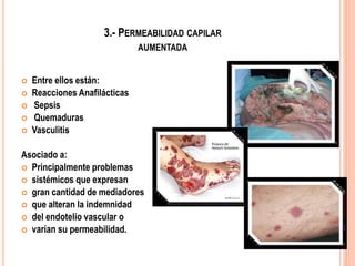Sindrome Edematoso | PPTX