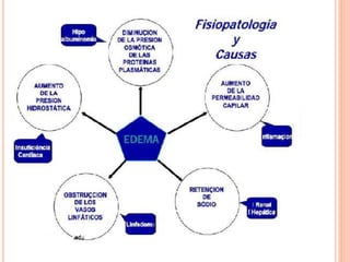 Sindrome Edematoso | PPTX