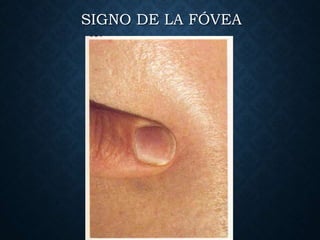 Sx edematoso Sx edematoso síndrome edematoso emsindrome e | PPTX