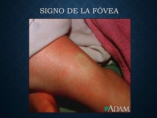 Sx edematoso Sx edematoso síndrome edematoso emsindrome e | PPTX