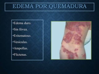 Sx edematoso Sx edematoso síndrome edematoso emsindrome e | PPTX