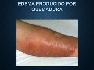 Sx edematoso Sx edematoso síndrome edematoso emsindrome e | PPTX