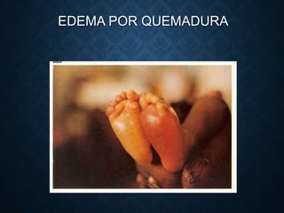 Sx edematoso Sx edematoso síndrome edematoso emsindrome e | PPTX