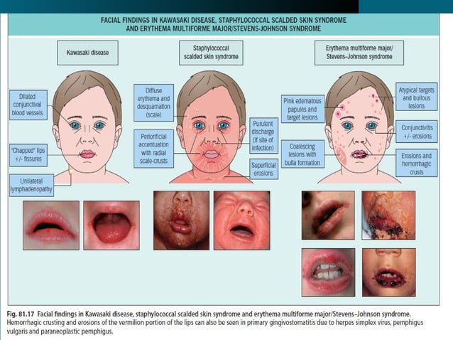 Sindrome estafilocócico de la piel escaldada