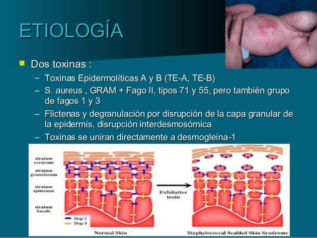 Sindrome estafilocócico de la piel escaldada