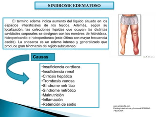 Sindrome febril y edematoso | PPTX
